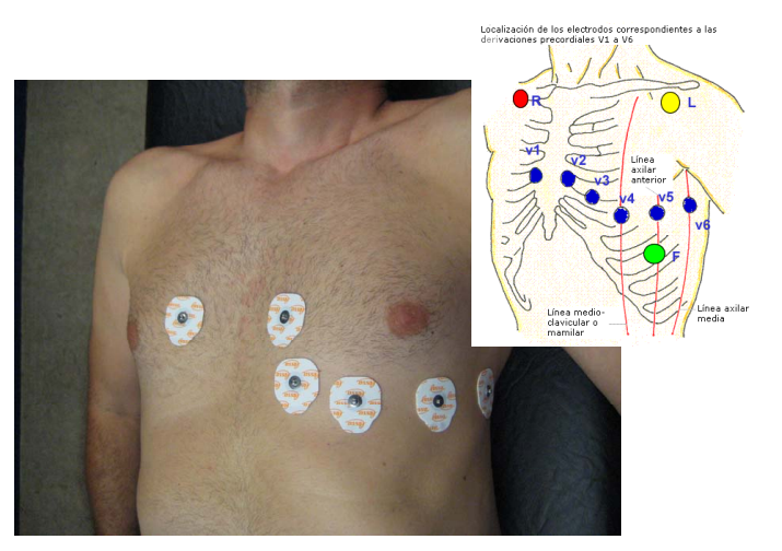 APRENDE APLICAR LOS ELECTRODOS ECG + VIDEO - Medicina mnemotecnias