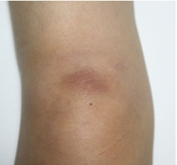 Unexplained Bruises On Legs Even Though There Is No Trauma : Real Story