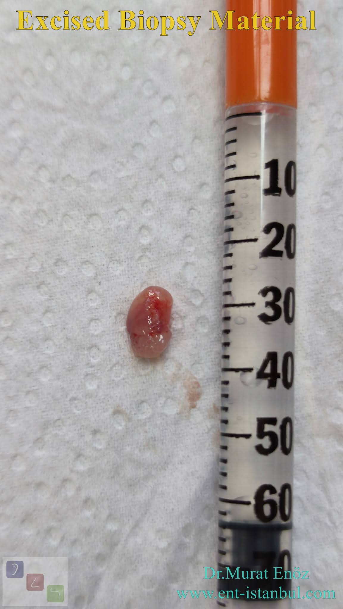 A Simple Partial Uvulectomy Technique Under Local Anesthesia For The ...