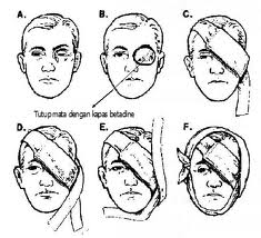 materi p3k: membalut luka pada daerah kepala