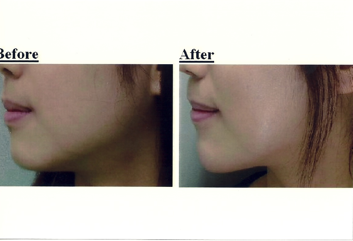 One Stop Beauty: Rahang simetris berbentuk 'almond' tanpa operasi ...