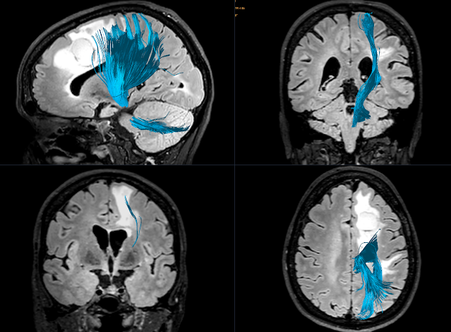 MRI Tractography - Brain Tumor