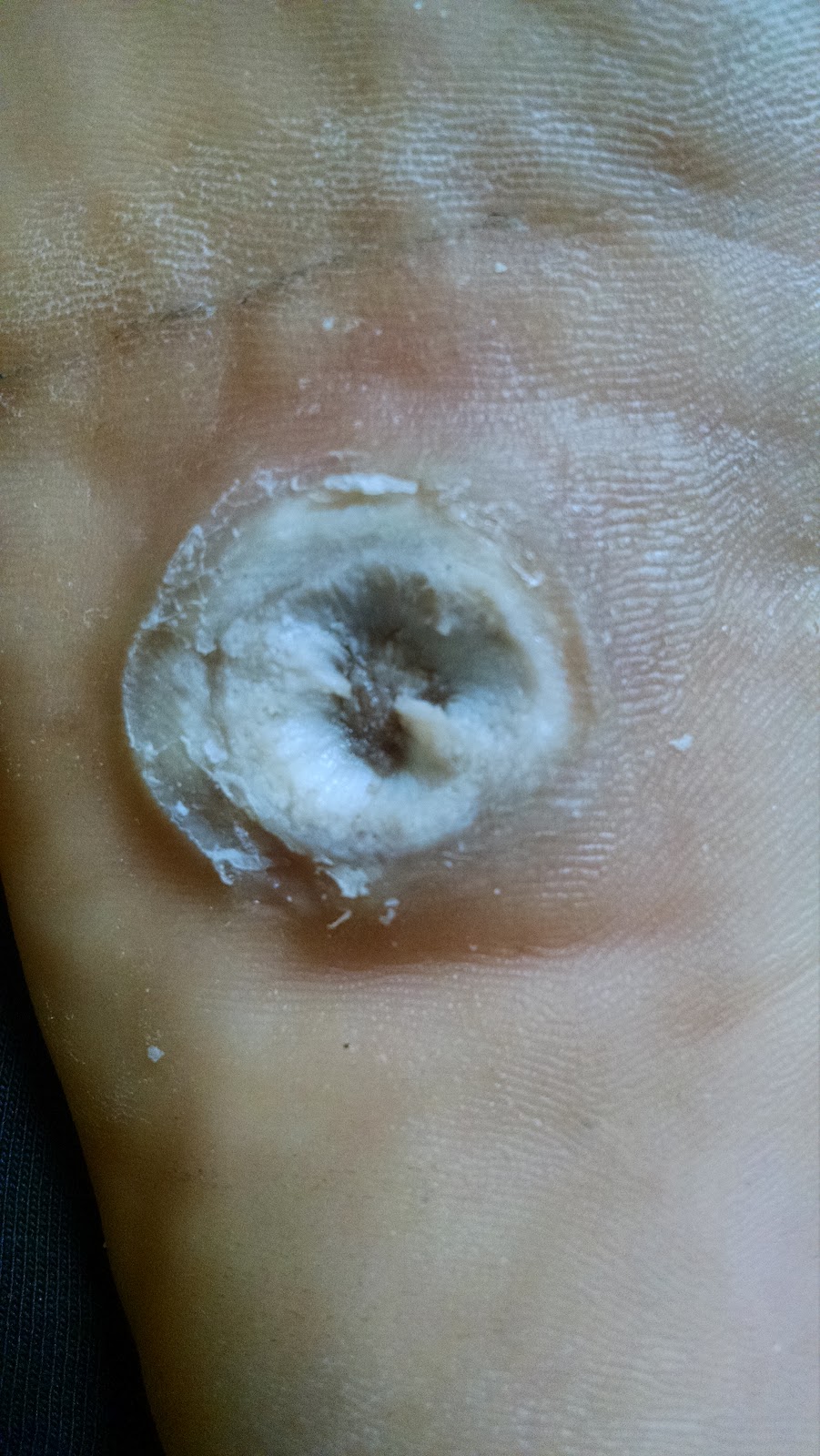 Verruca Plantaris (Planter Wart) Cure: Nov Part 1