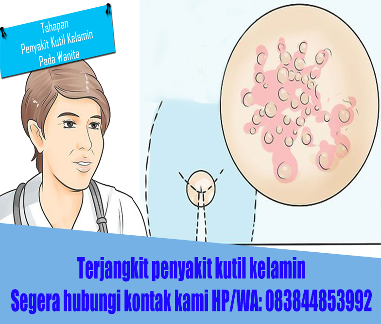 Pengobatan Sampai Tuntas Hilangkan Kutil Kelamin Di Kimia Farma