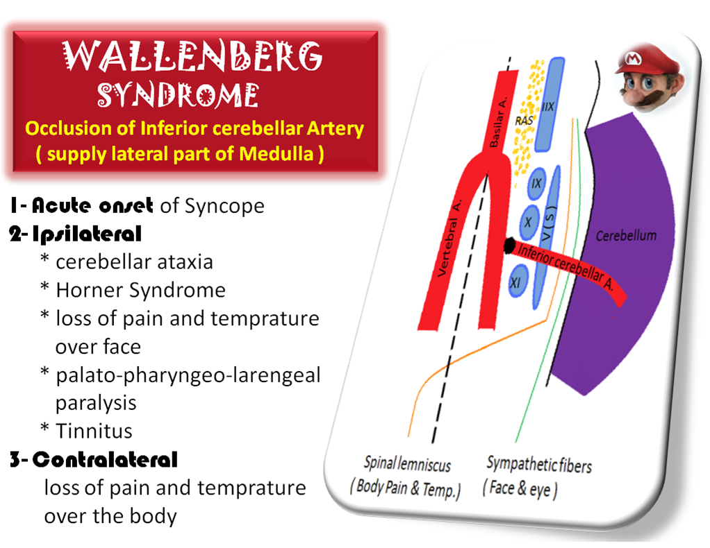 Wallenberg Syndrome-Occlusion of Inferior Cerebellar Artery ~ Medicosapiens