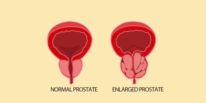 Apa itu Prostat, dan Apa Fungsinya Bagi Pria? | Belajar Sampai Mati