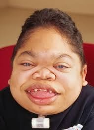 Medical Treatment Pictures-for Better Understanding: Maroteaux-Lamy ...