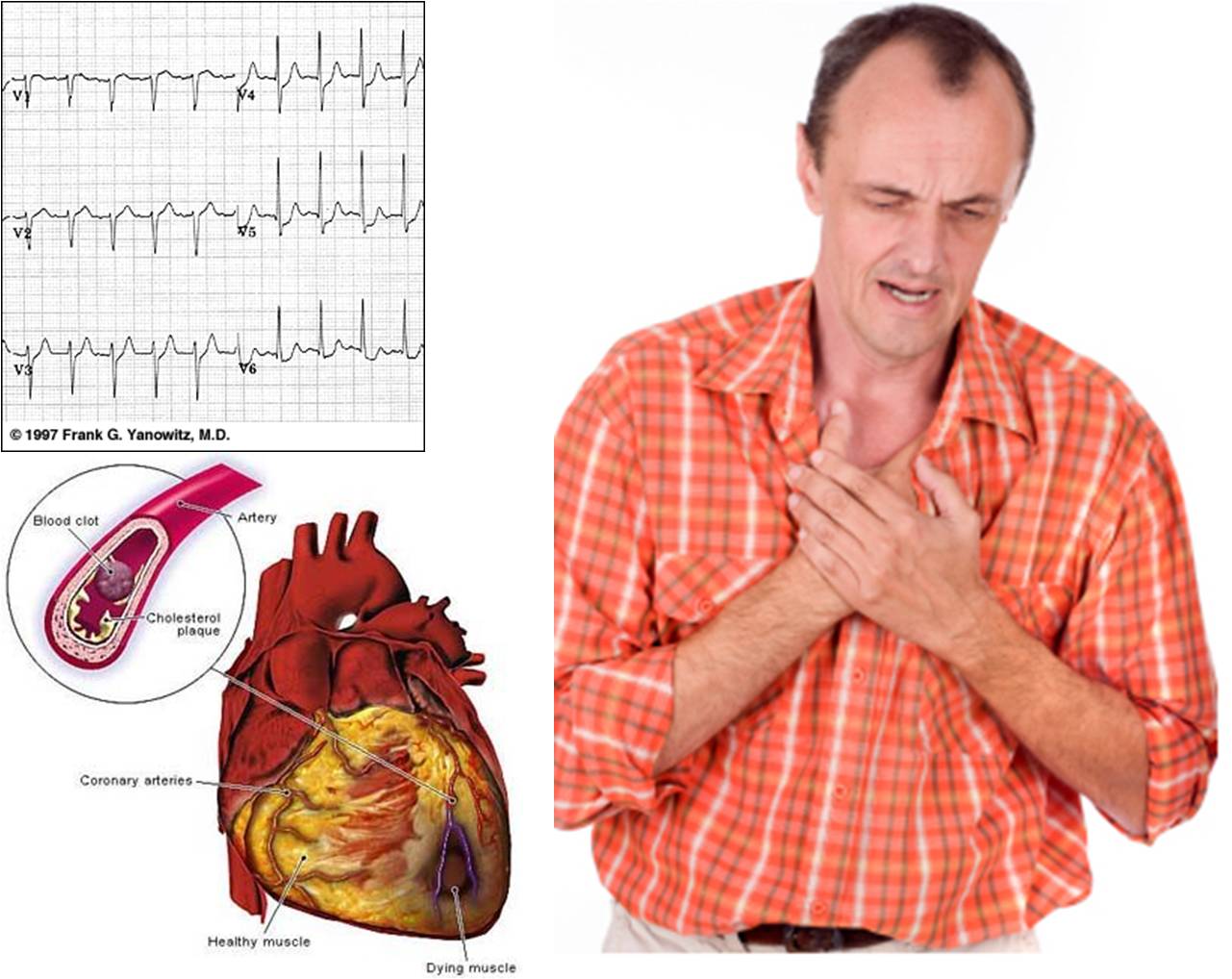 Infarto Agudo al Miocardio (IAM) - Mind Map