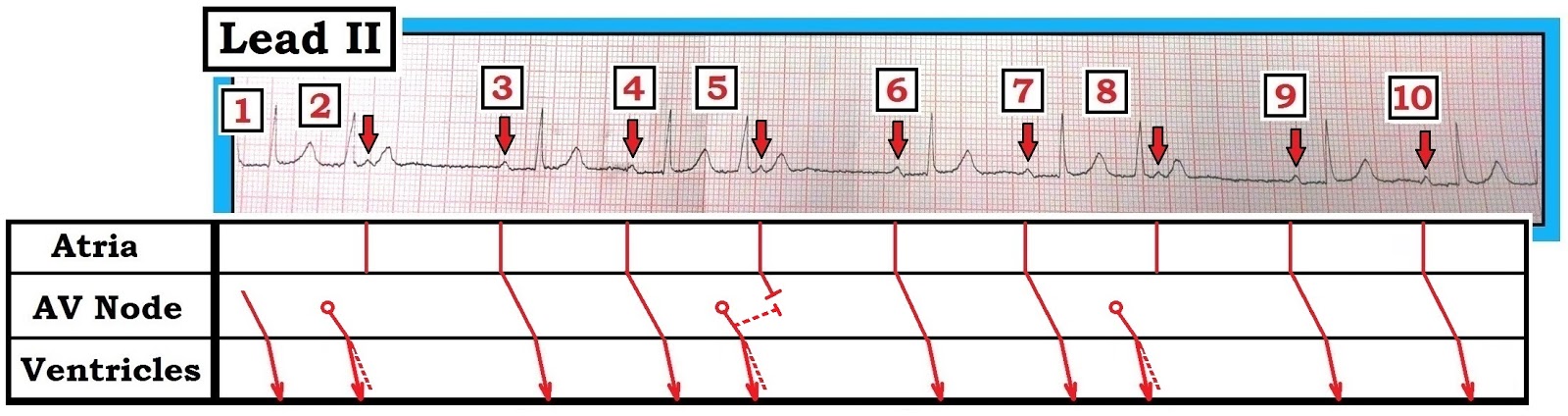 ECG Interpretation: ECG Blog #69 (Laddergrams – Group Beating)
