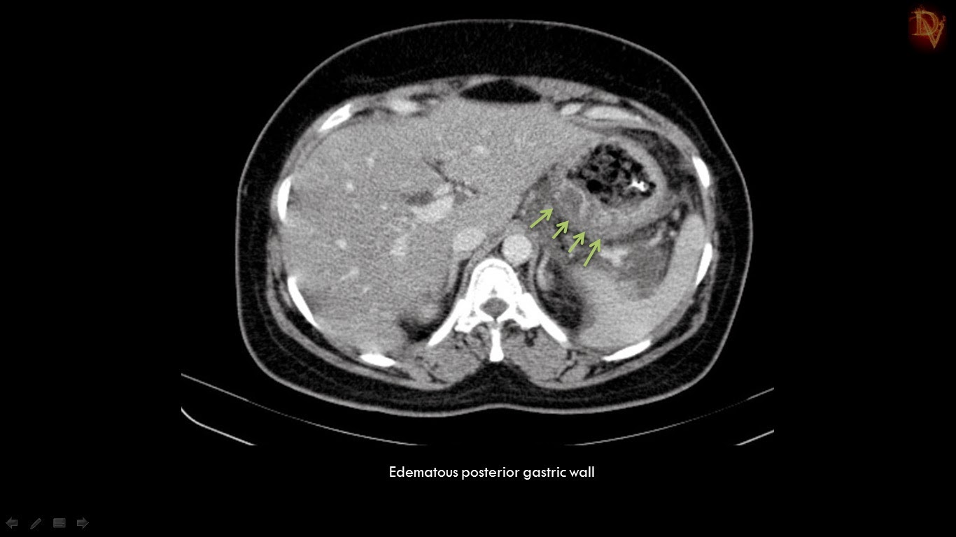Ultimate Radiology : Acute Necrotizing Pancreatitis