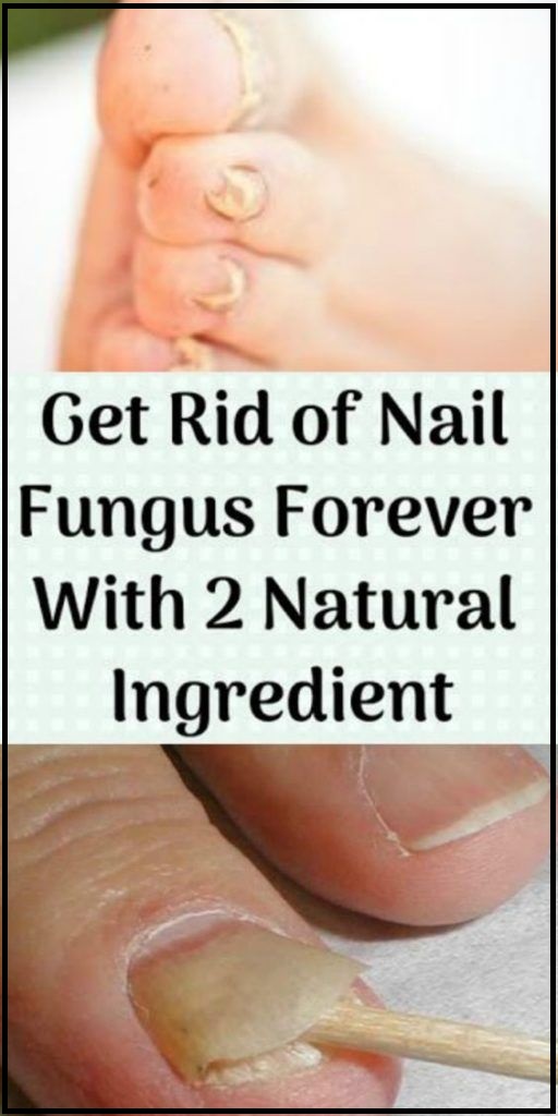 Get Rid of Nail Fungus Forever – 2 Ingredient Recipe - wellness days