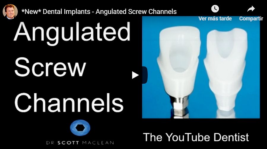 IMPLANTOLOGY: New Dental Implants - Angulated Screw Channels - Odonto-Tv