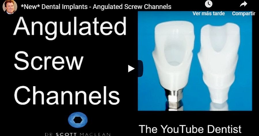 IMPLANTOLOGY: New Dental Implants - Angulated Screw Channels - Odonto-Tv