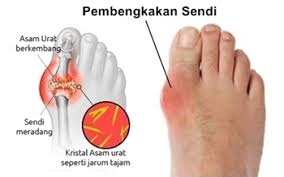 DOKTER SPESIALIS PENYAKIT KELAMIN: MENGOBATI GEJALA ASAM URAT SECARA ...