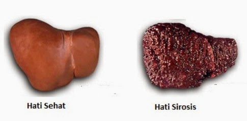 DIET PENYAKIT HATI ~ AgitaBolaboli