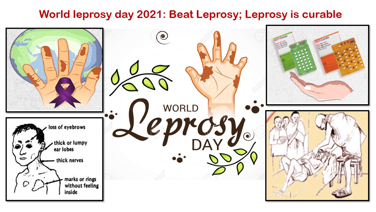 The Family physician : World leprosy day 2021: Beat Leprosy; Leprosy is ...