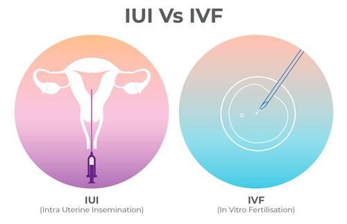 IUI or IVF? Which is the right option for you?