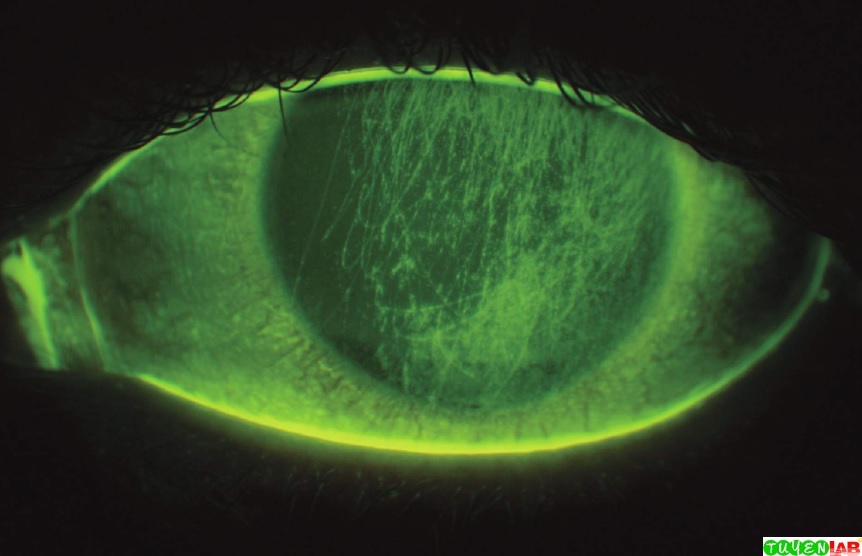 [Emergency] Atlas of Corneal Abrasion | Free Medical Atlas
