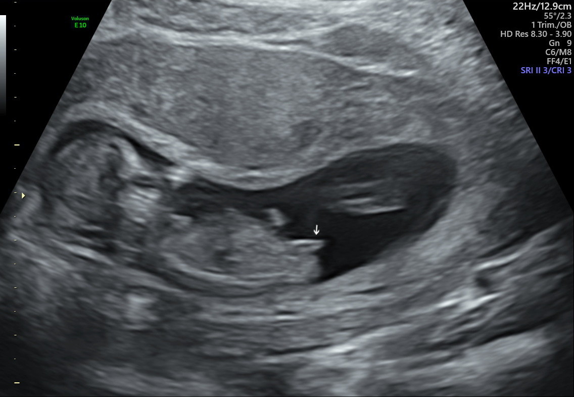 Fetal Diagnostic: 1st Trimester Screening