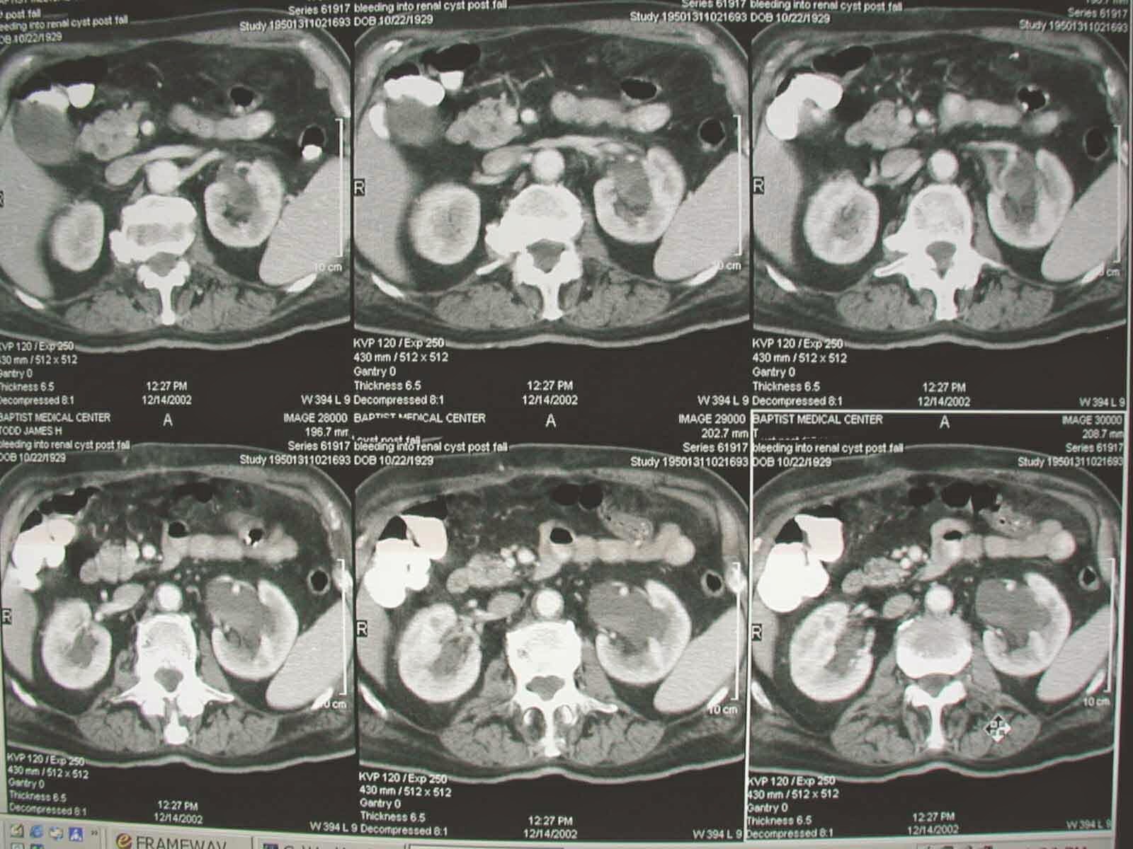 Wellness Lab Health Info: What To Do With My Kidney Cyst??