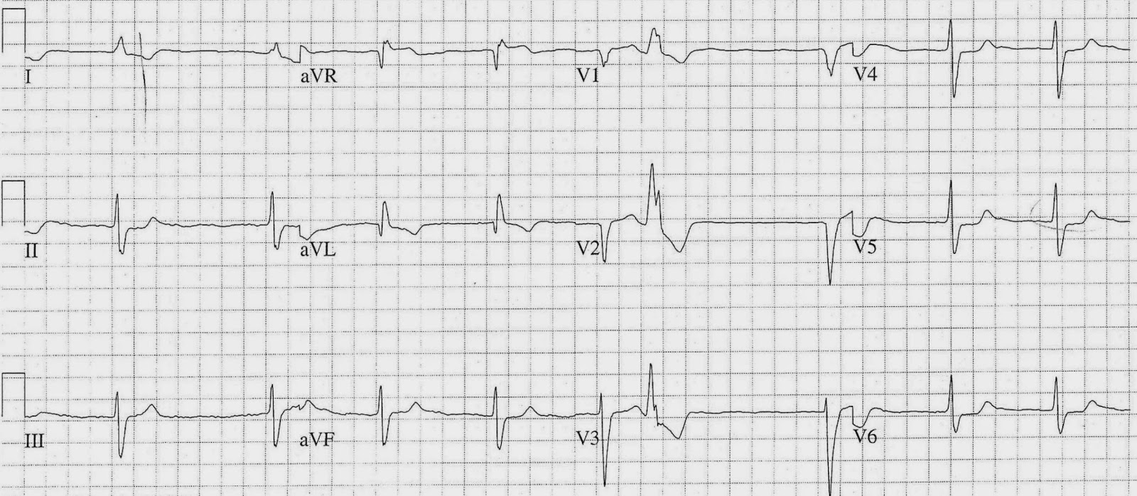 ECG of the Week: ECG of the Week - 27th April 2015