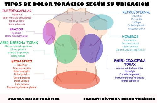 Infarto agudo al miocardio