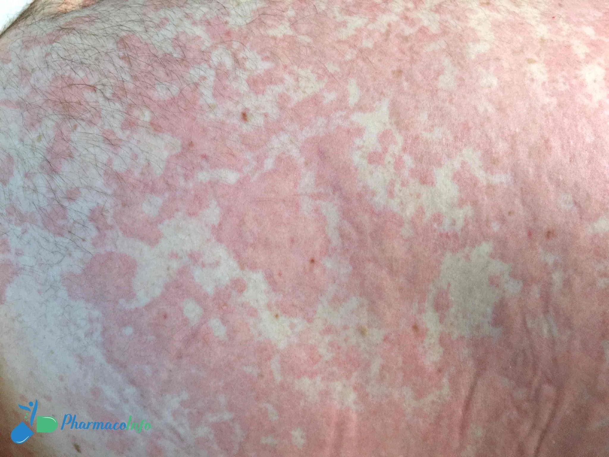 Urticaria overview, urticaria definition, urticaria cause, urticaria ...