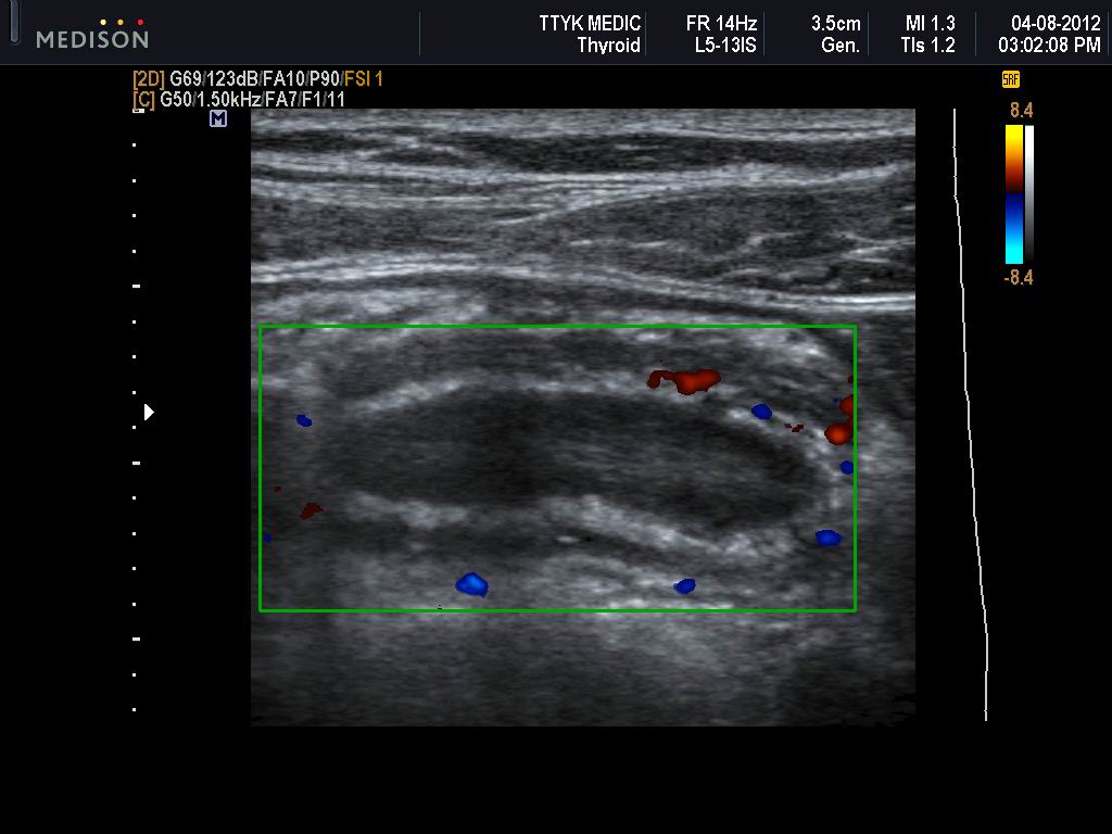 VIETNAMESE MEDIC ULTRASOUND: CASE 137: APPENDIX TUMOR, Dr PHAN THANH ...