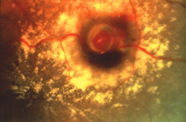 Journal and Conferences on Ophthalmology: Best treatment for Retinal ...