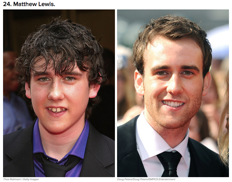 Matthew Lewis Teeth Before And After
