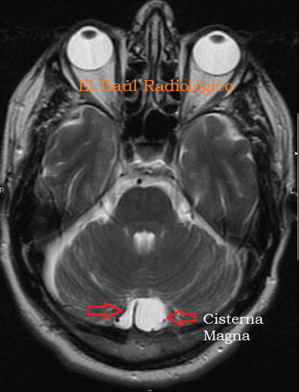 El Baúl Radiológico: ASPECTO DE LA CISTERNA MAGNA EN TOMOGRAFÍA ...