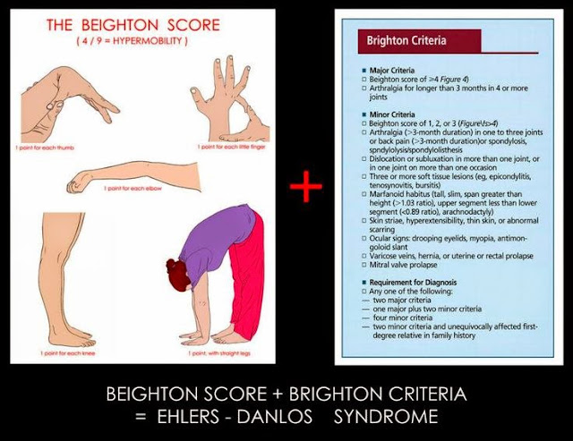 K.C. Wells: EDS Awareness Month