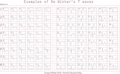 ECG Educator Blog : De Winters T waves