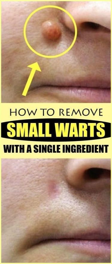 How To Remove Small Warts Using 1 Simple Ingredient how-to-remove-small-warts-using-1-simple-ingredient