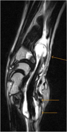 Space of Parona Infection-MRI - Sumer's Radiology Blog