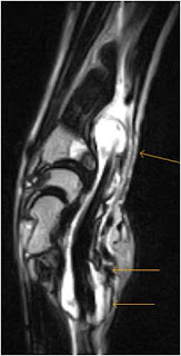 Space of Parona Infection-MRI - Sumer's Radiology Blog