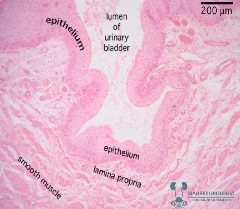 Madrid Urología: Cáncer de Vejiga. Histología 1. MU. Capítulo 2.