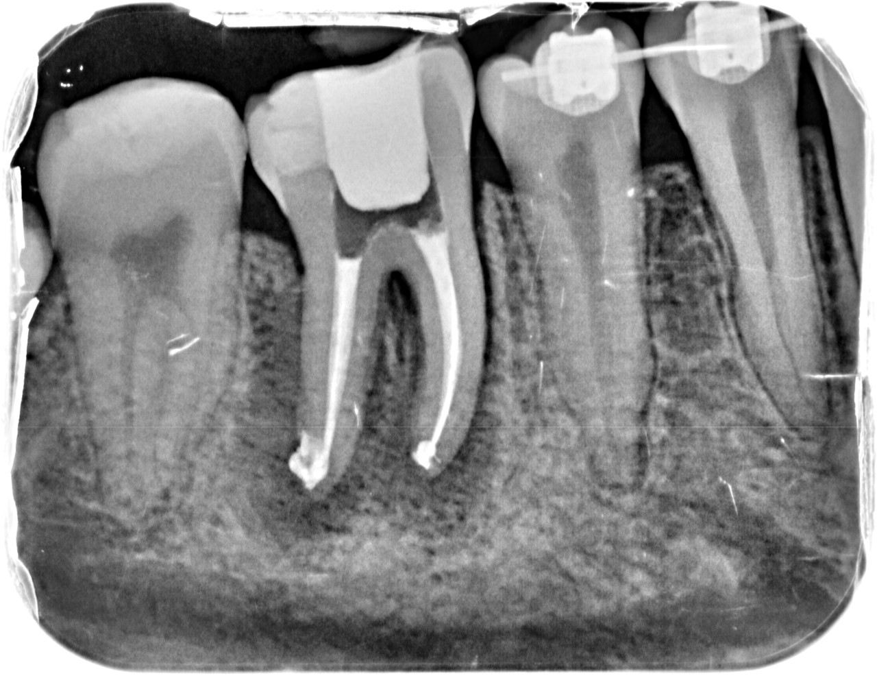 Caso Clínico Master: movida orto-endo