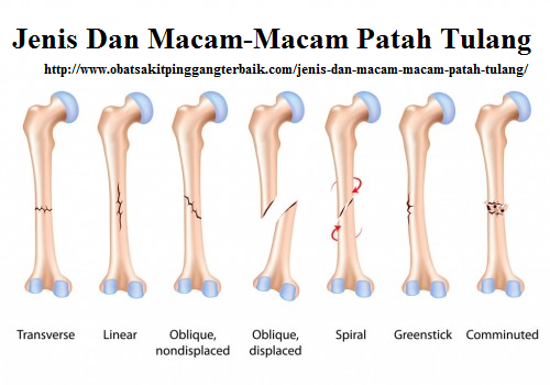 Rawatan Patah Tulang : Ikhtiar Dengan Vivix