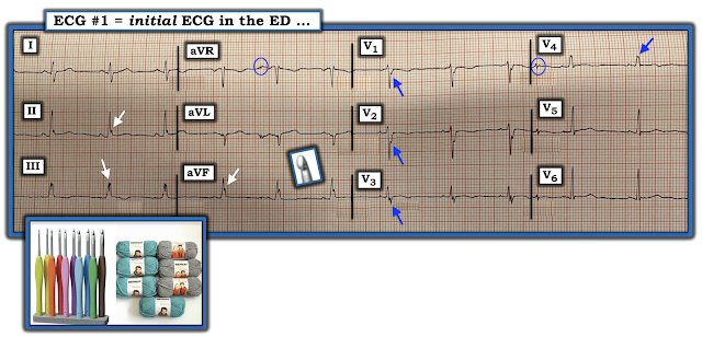 Dr. Smith's ECG Blog: A young woman with epigastric pain. ECG ...