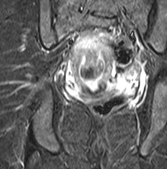 RADIODIAGNOSIS - IMAGE COLLECTION: SUBMUCOSAL UTERINE FIBROID