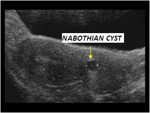 Nabothian Cyst : Cause - Identification -Symptoms - Complications ...