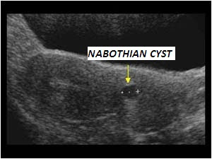 Nabothian Cyst : Cause - Identification -Symptoms - Complications ...