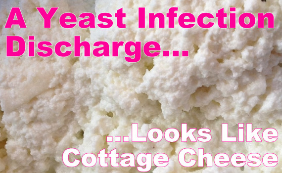 Yeast Infection Discharge Cottage Cheese