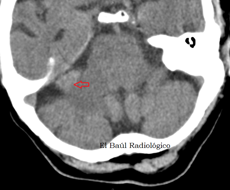 El Baúl Radiológico: LÓBULO FLOCULONODULAR CEREBELOSO. (The Cerebellar ...