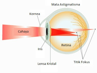 Cara Mengobati Mata Rabun Dan Buram Sebelah Kanan Secara Alami ~ masa subur