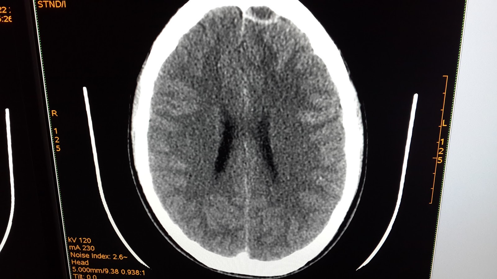 EL RINCON DEL INTERNISTA: Mucocele frontal y absceso epidural ...