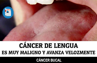 CÁNCER BUCAL: Cáncer de lengua es muy maligno y avanza velozmente