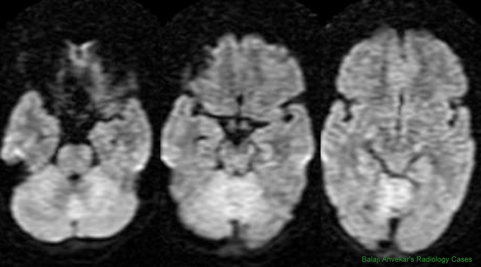 Dr Balaji Anvekar's Neuroradiology Cases: Acute cerebellitis MRI