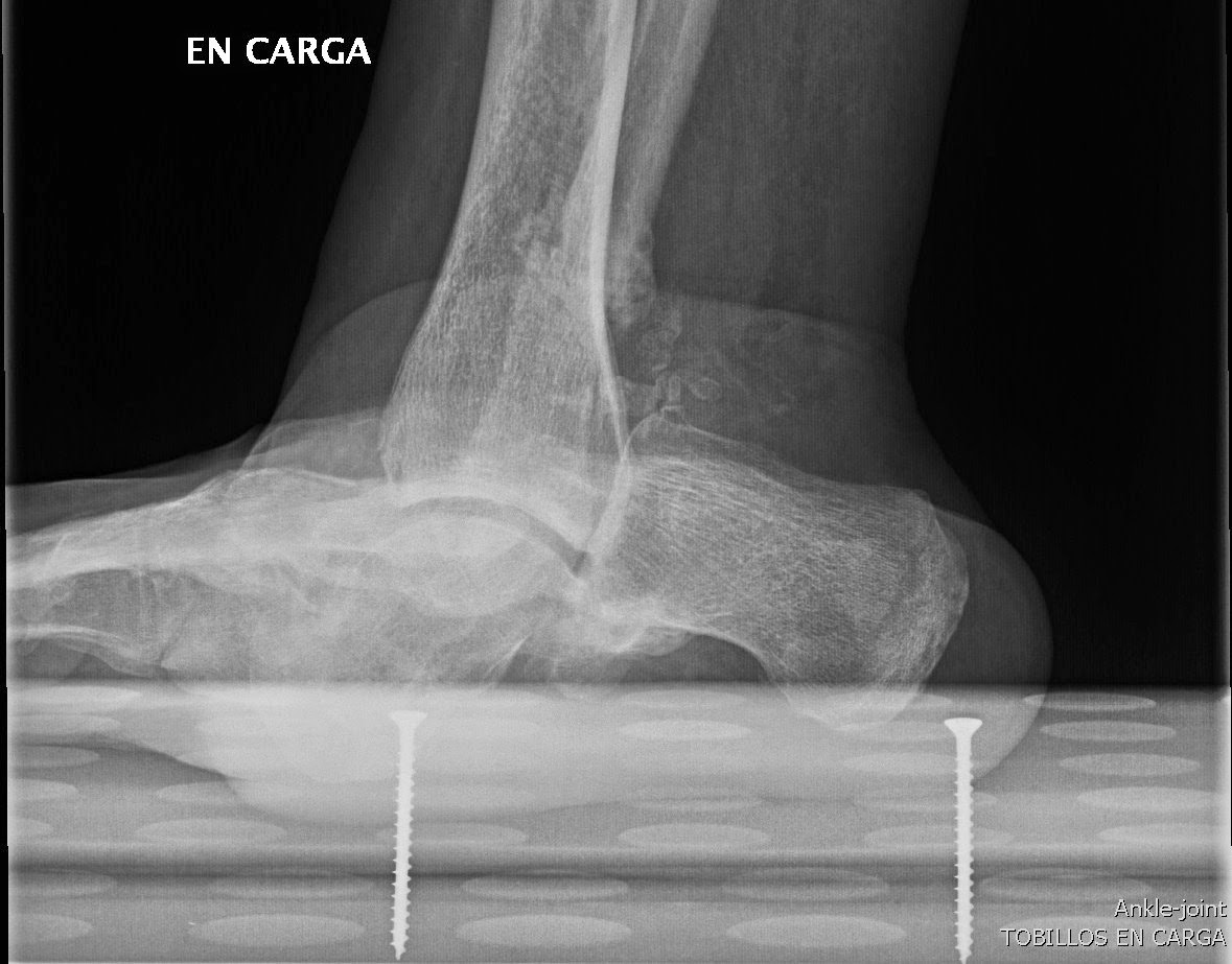 Salud Osteoarticular: CORRECCIÓN DE PIE PLANO-VALGO REUMATICO